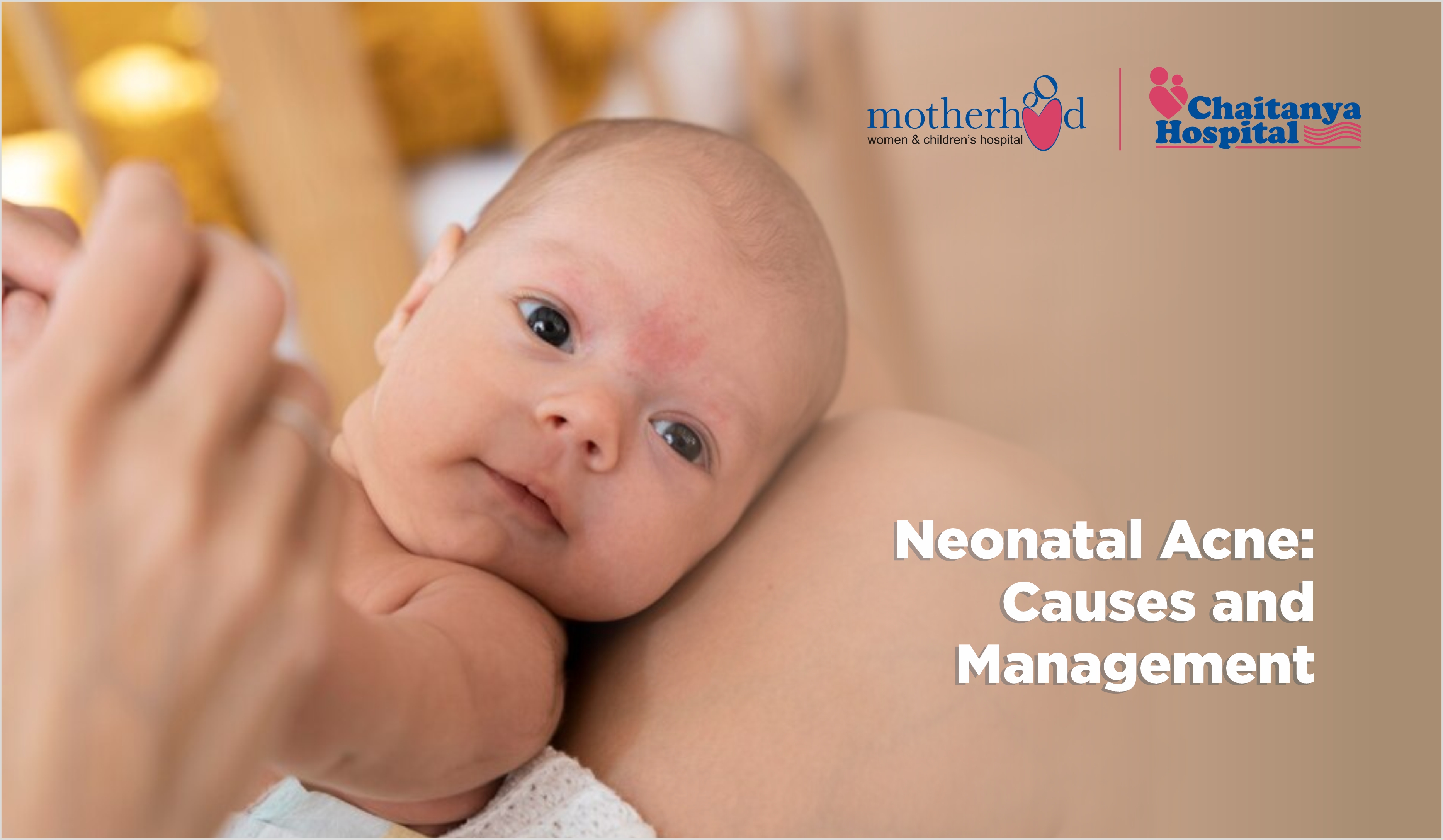 Neonatal Acne Causes And Management Motherhood Chaitanya Hospitals